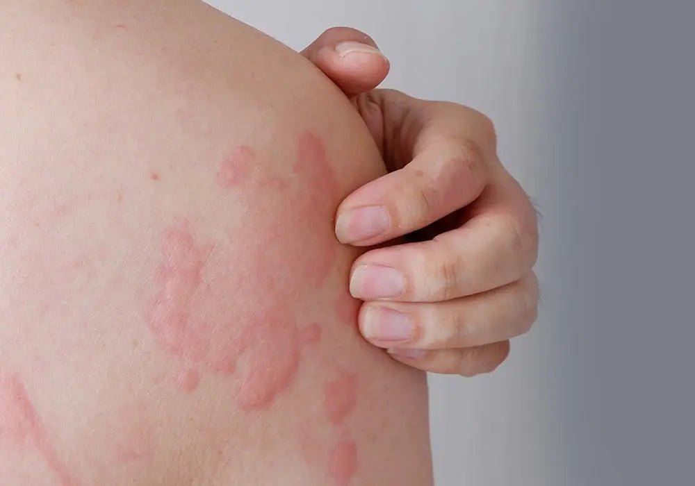 3 Ciri Alergi Debu dan Cara Mengatasinya dengan Cepat