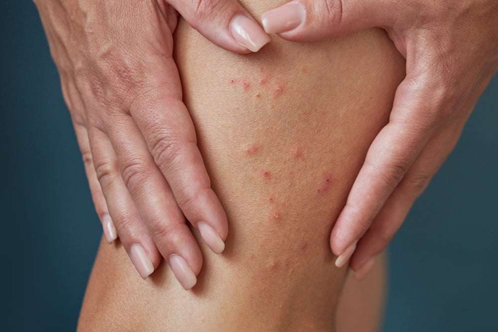 Tungau Scabies Penyebab Kudis, Ini Cara Mencegahnya!